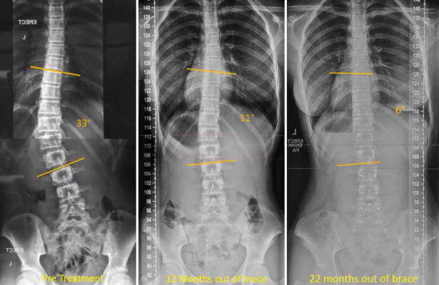 ICD Code for Scoliosis: Detailed Overview of the ICD Code System for ...